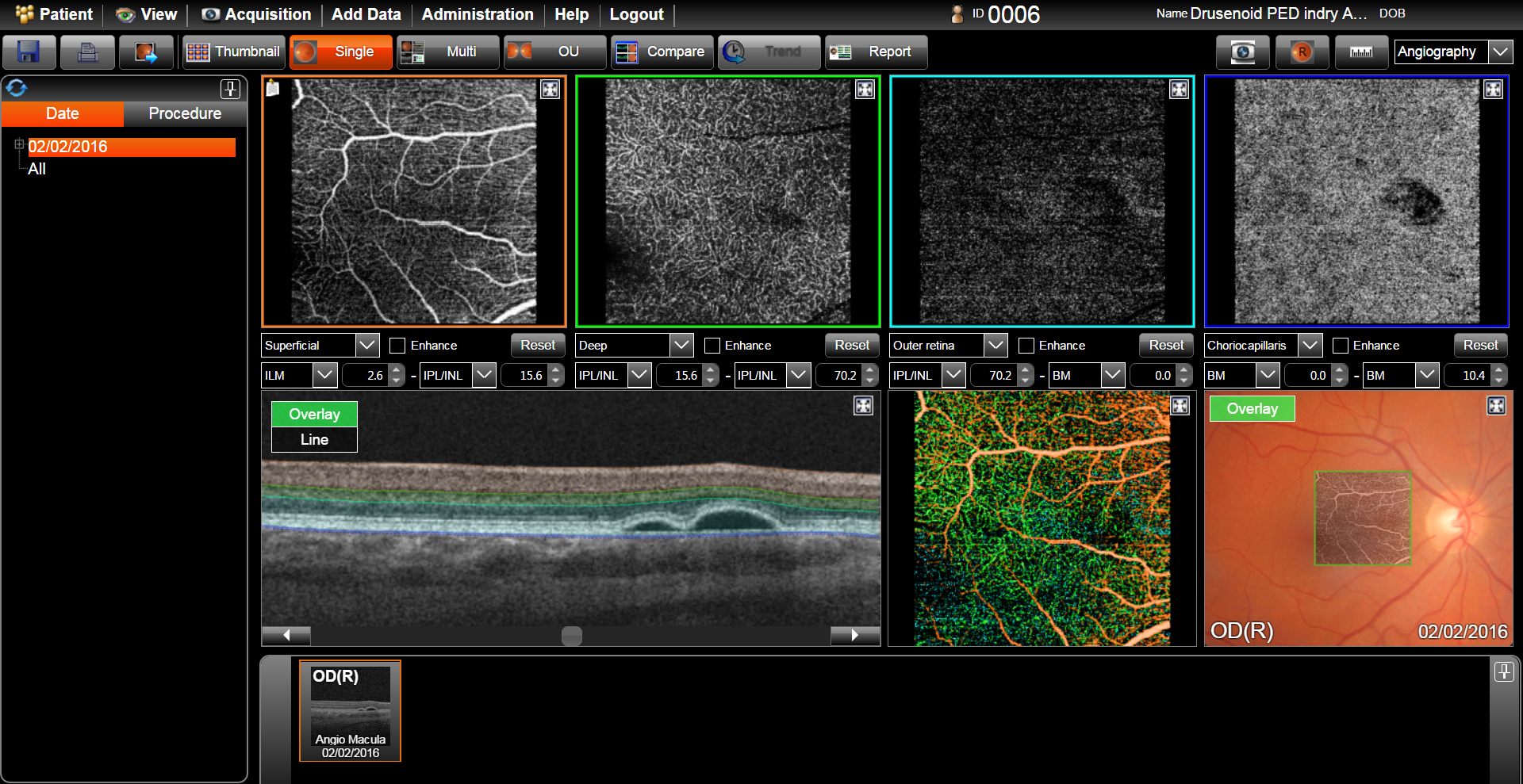 OCT (Tomógrafo de Coherencia Óptica) | Opticare Equipos Oftalmológicos